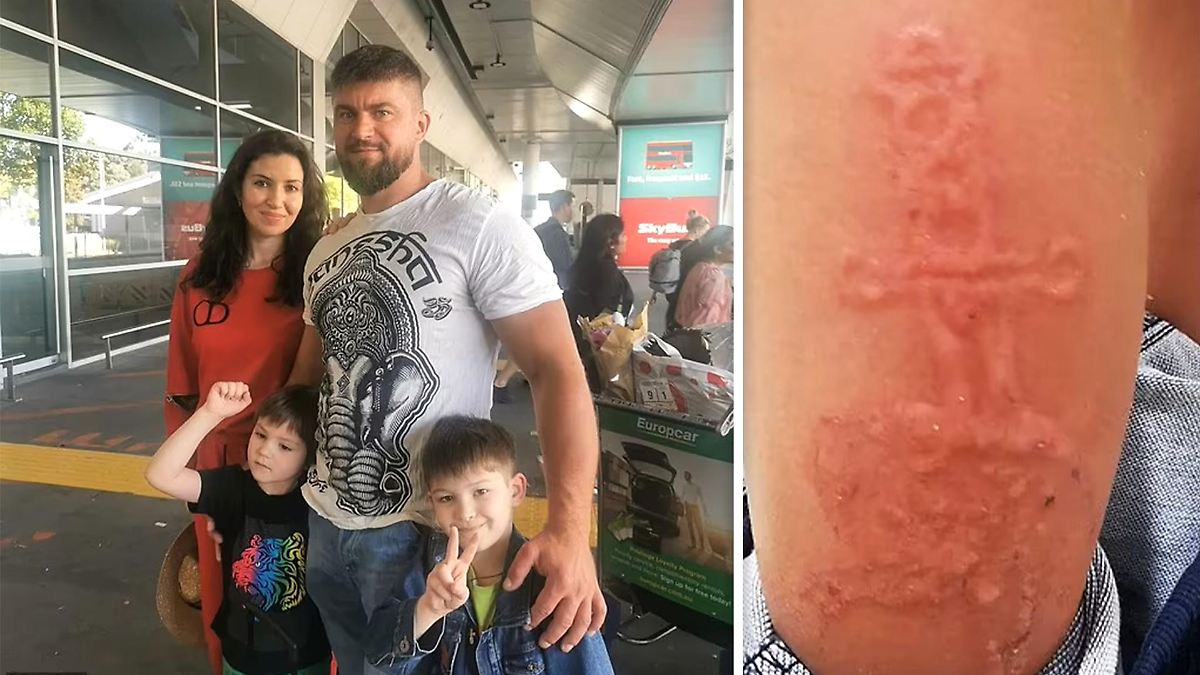 Urlaubs-Horror für Familie: Kinder haben nach Henna-Tattoo schwere ...