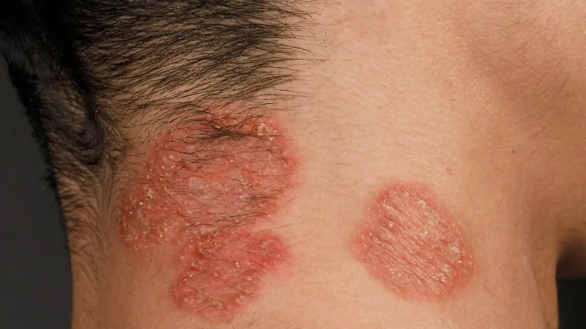 Pfleger Ricardo Lange kämpft mit Hautkrankheit Rosacea: „Schäme mich“