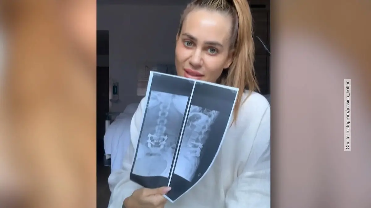 Update nach Wirbelsäulen-OP: Jessica Haller zeigt ihren neuen Rücken mit Schrauben