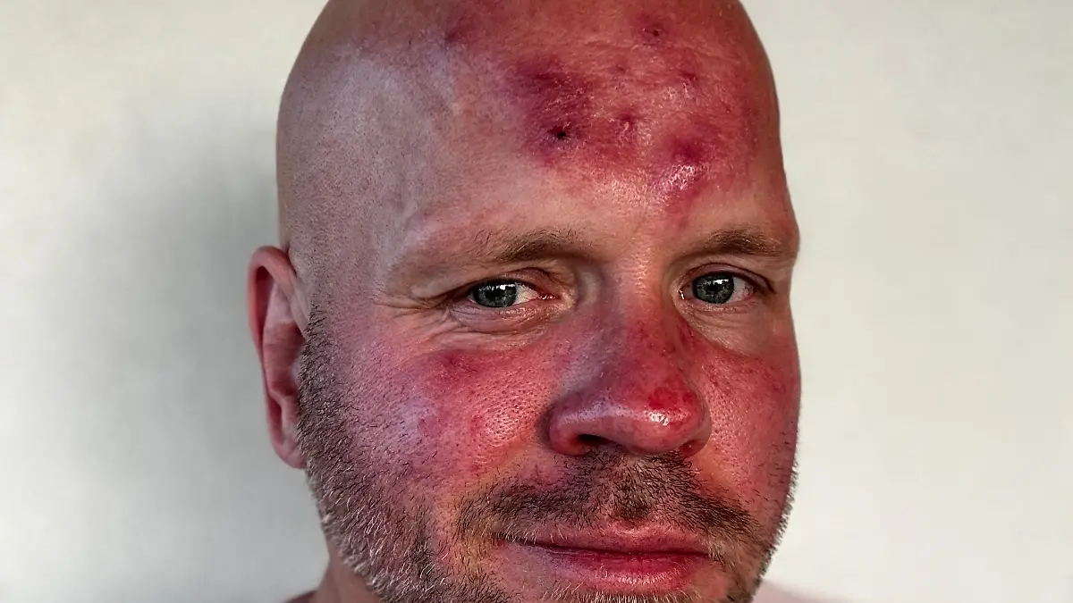 Pfleger Ricardo Lange kämpft mit Hautkrankheit Rosacea: „Schäme mich“