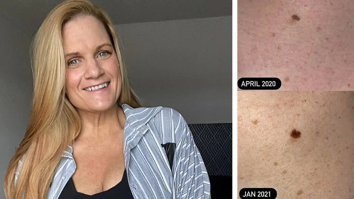 Frau bekommt Hautkrebs – zweimal hintereinander: „Ich war süchtig nach ...