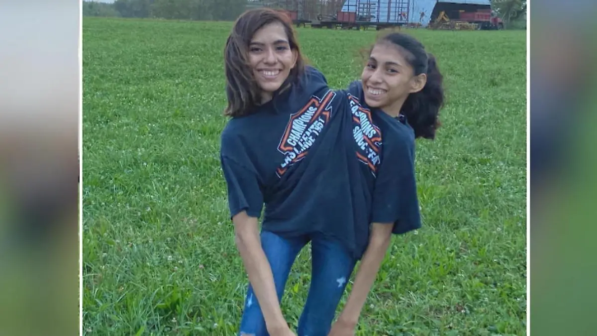 Seltene Form von siamesischen Zwillingen: Spinnen-Zwillinge teilen sich ...