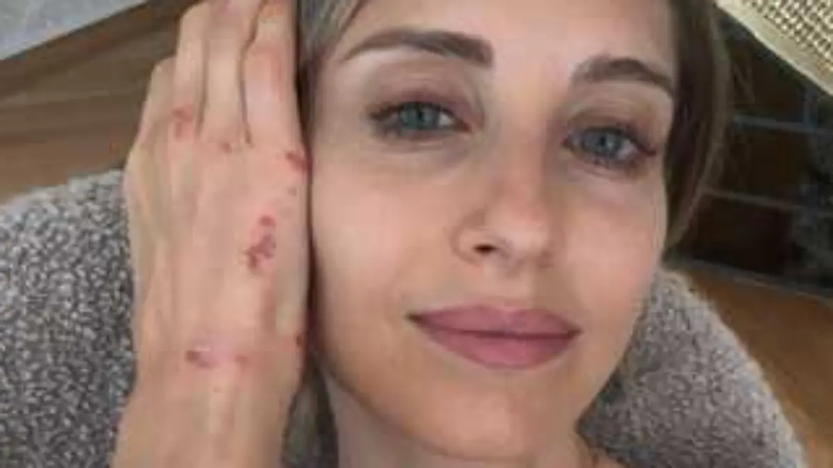 Cathy Hummels nach bösem Unfall in Klinik: Jetzt erklärt sie RTL, was ...