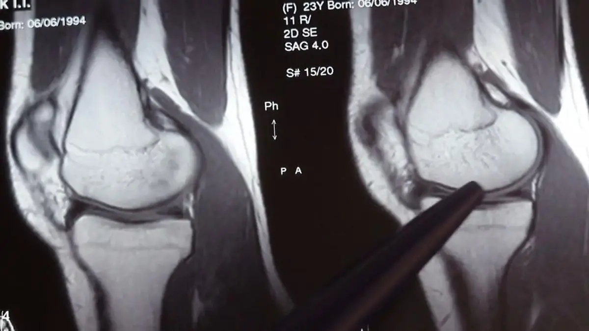 Gesundheitslexikon: Meniskusriss