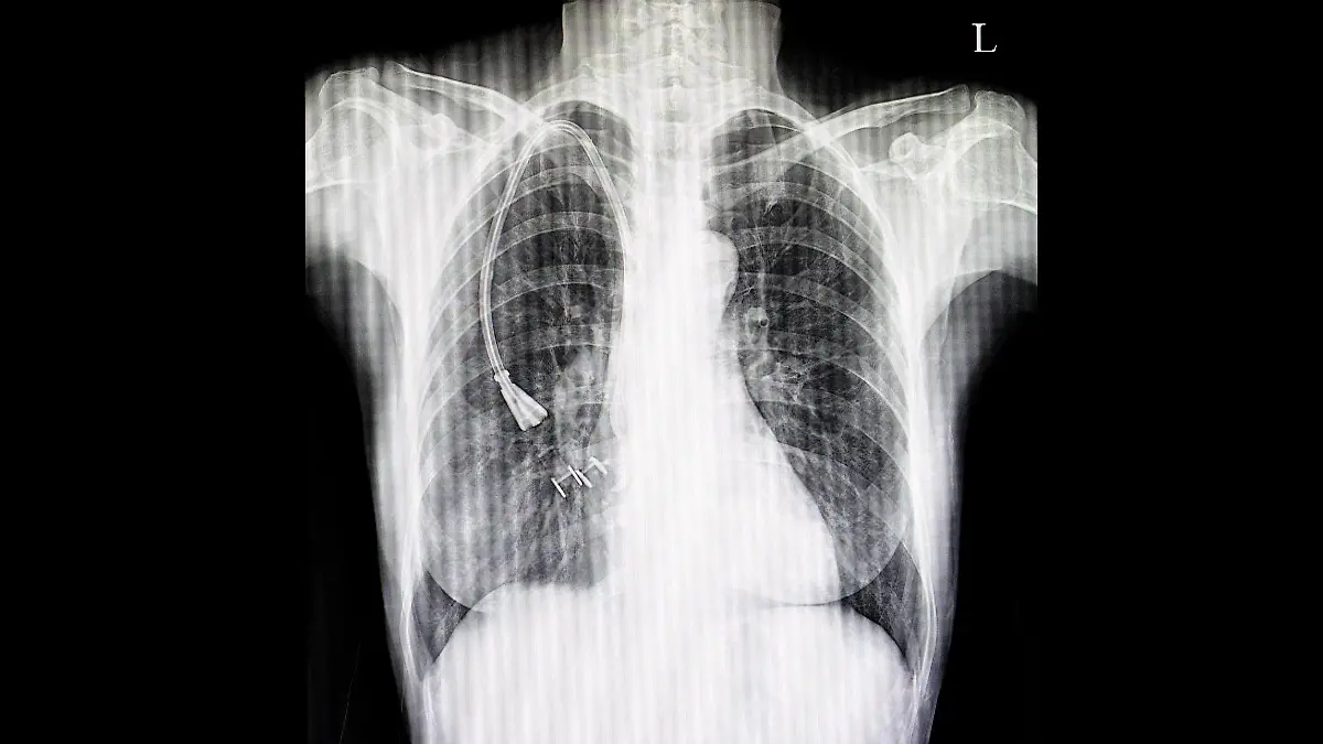 Gesundheitslexikon: Thoraxdrainage (Pleuradrainage)